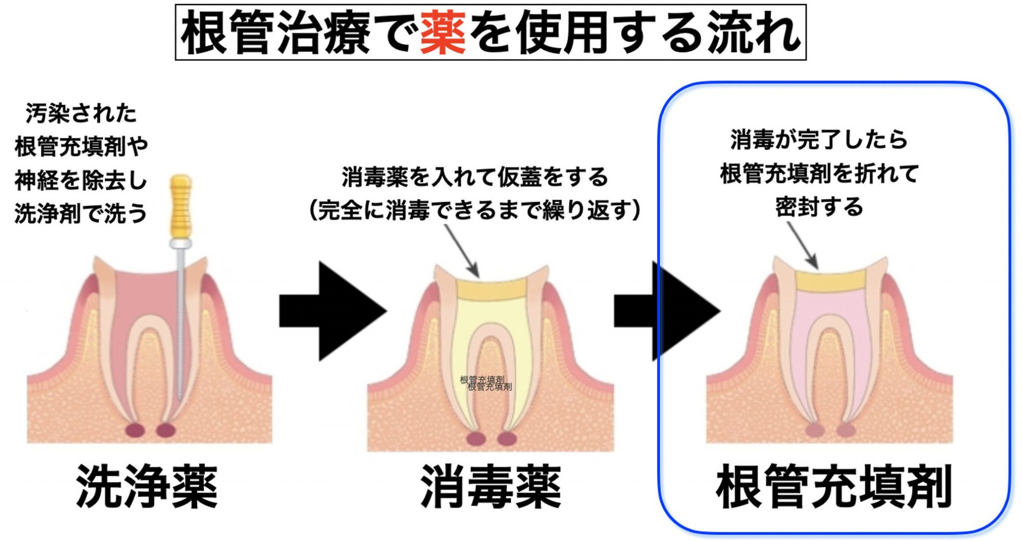 現役歯科医解説!根管治療の薬がもたらす不安や痛みの原因と対処法!