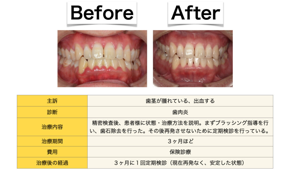 歯肉炎の治療で健康な歯茎を!腫れ、出血をなくすために